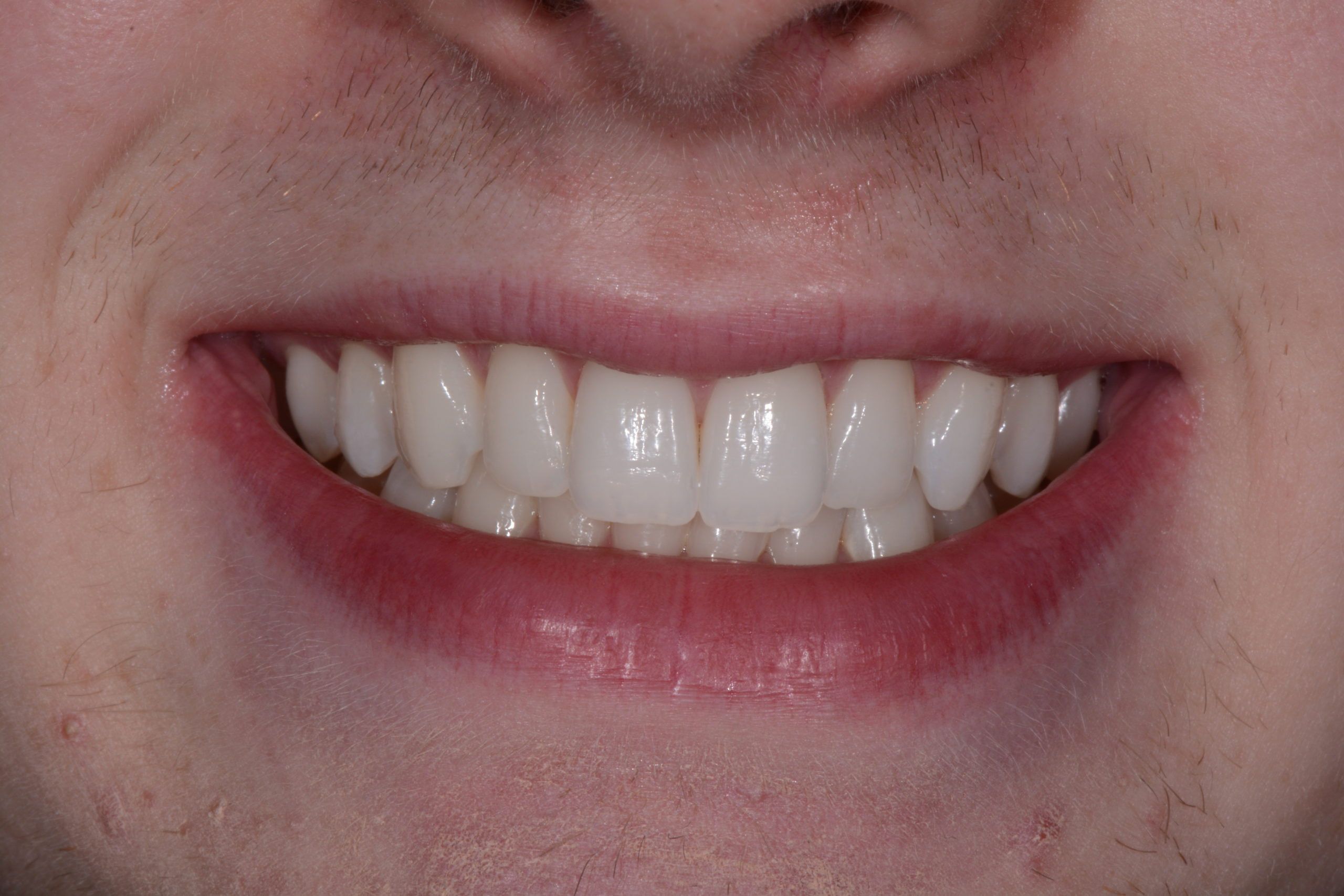 Enlighten Smiles Whitening Kits - offers.enlightensmiles.com